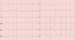 EKG: Kaffeesatzerbrechen